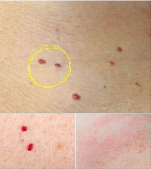 Achtung: Wenn du diese roten Punkte auf deiner Haut entdeckst, solltest ...